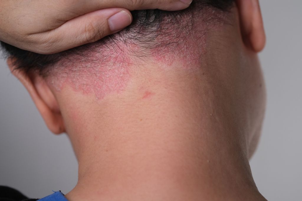Scalp Psoriasis What You Need To Know Cascade Eye And Skin Centers